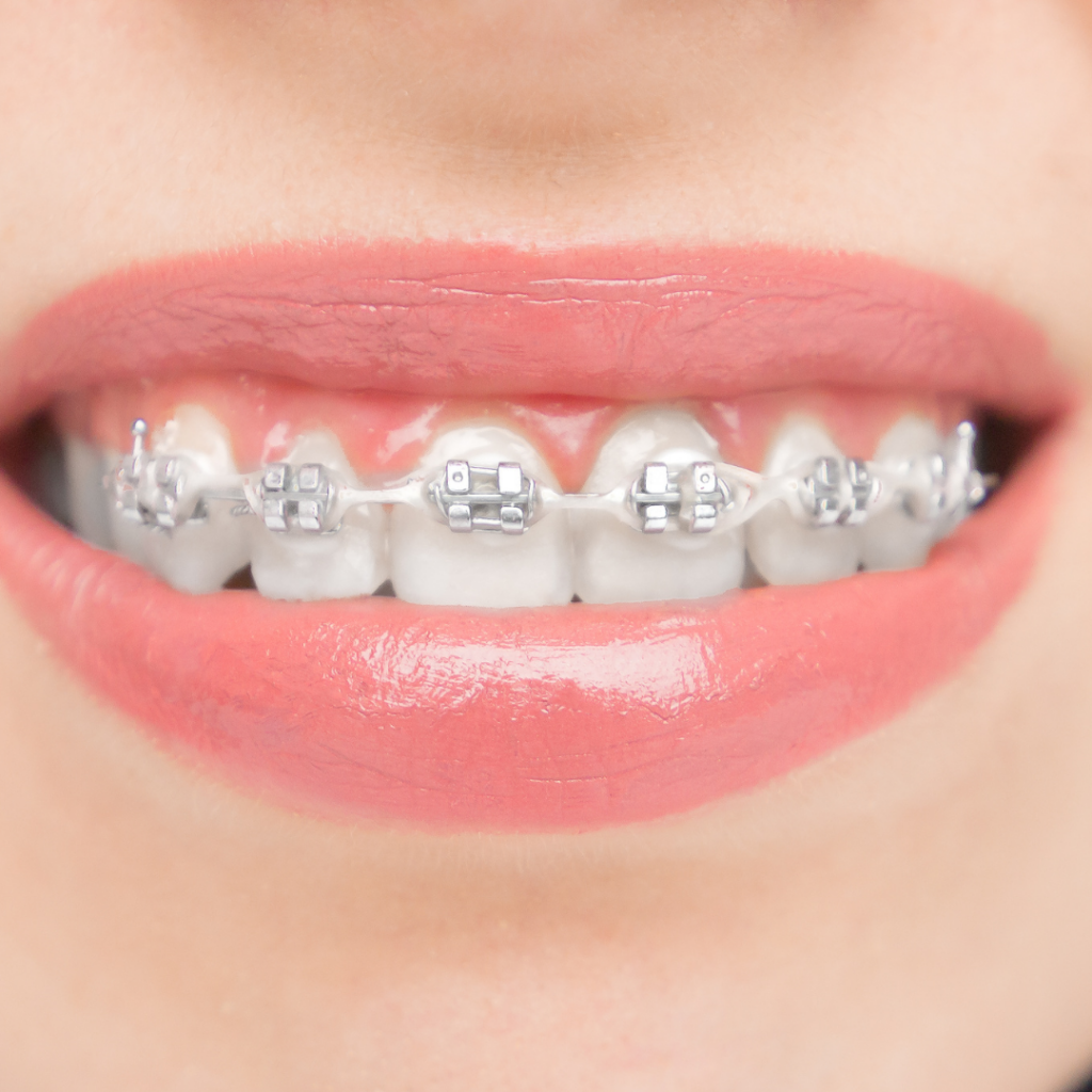 Fixed Braces - Cheshire Orthodontics