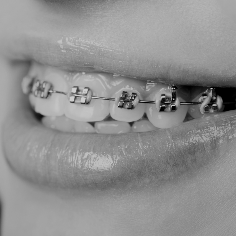 Fixed Braces - Cheshire Orthodontics